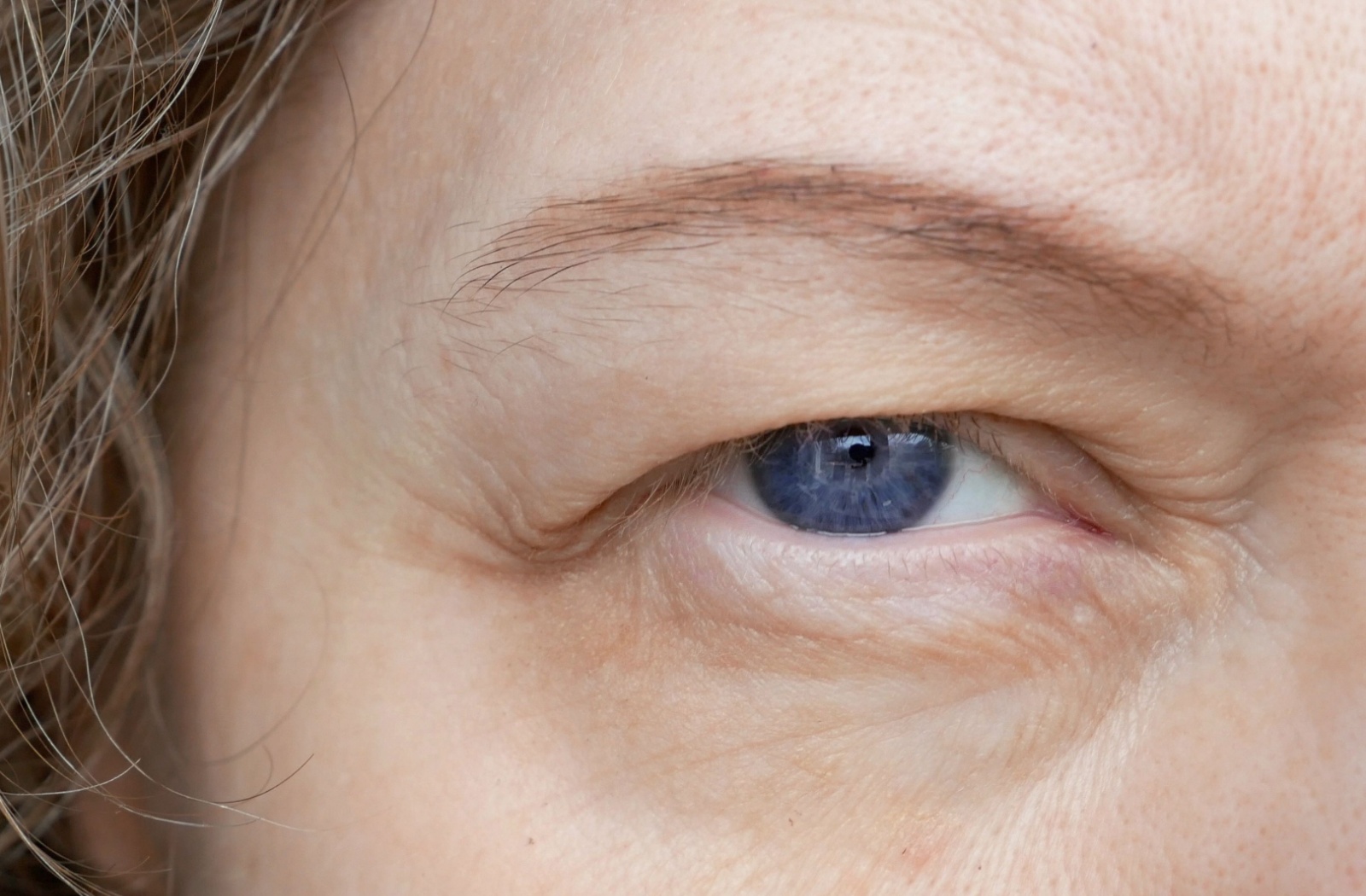 How To Fix a Droopy Eyelid? | Eyes on Plainville